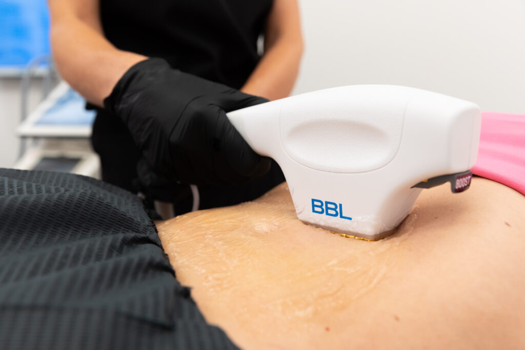 BBL Hero in Nashville - Skin & Allergy Center